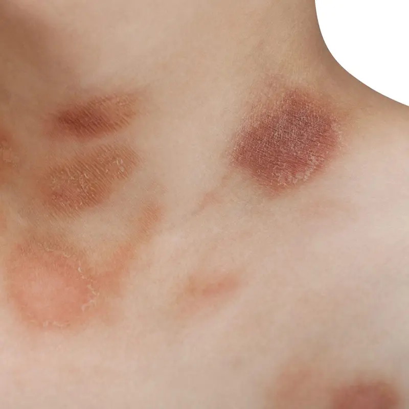 Pitiriasis Versicolor - Dra Norma Aguirre